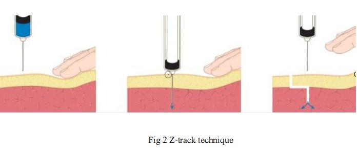 How to Inject Breast Filler? - Dermax