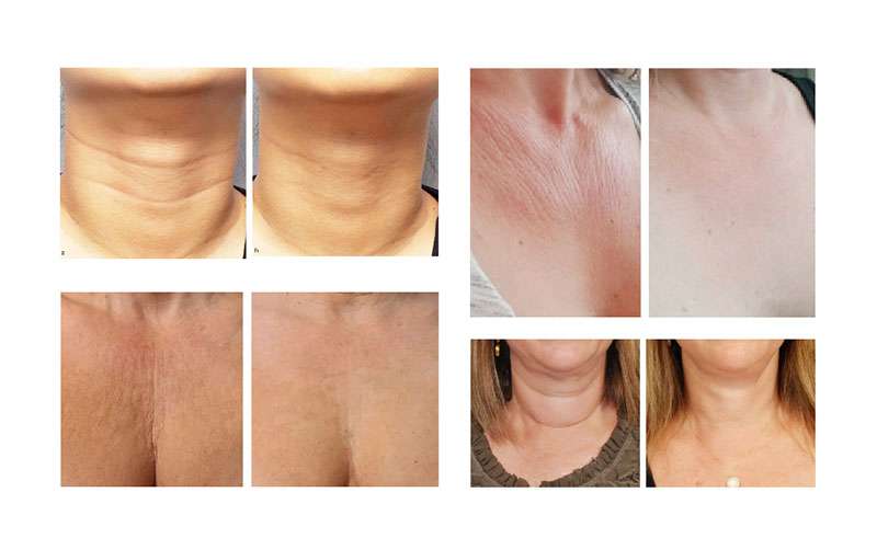 NutriDerm® Hylite best skin booster for neck - Dermax Medical