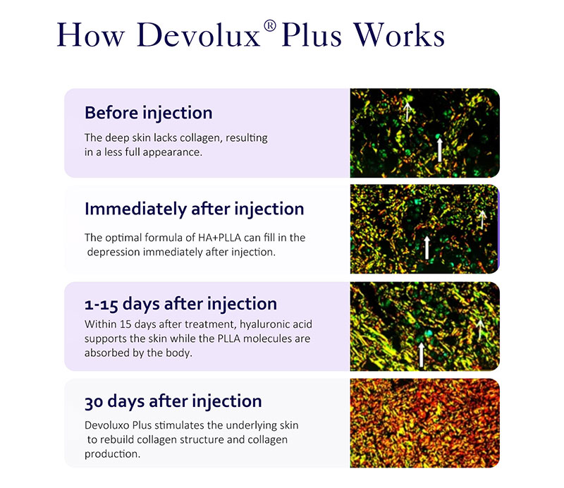 Devolux PLUS Breast Filler - Dermax