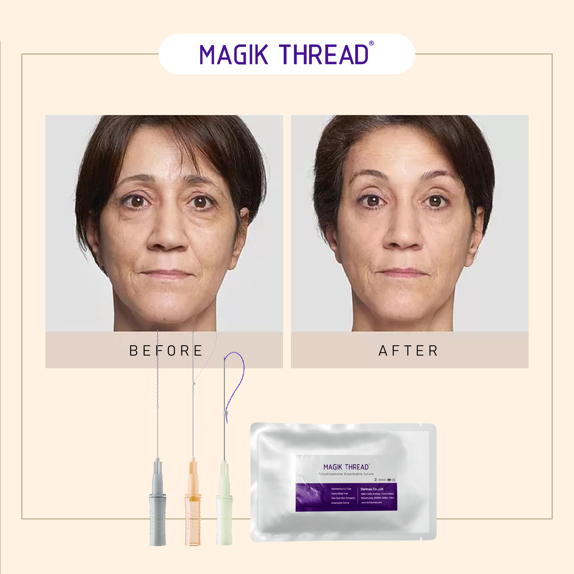 The Art Of PDO Thread Lift Placement: Elevate Your Aesthetic Practice With Magik Thread - Dermax