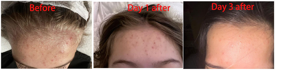 PDRN Injection Before And After: What You Need To Know - Dermax