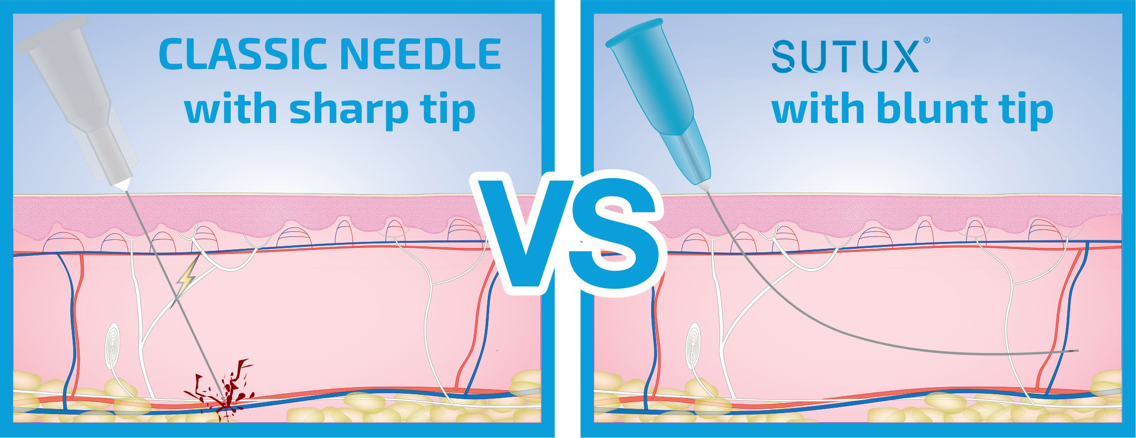 What Is The Cost Of The Pdo Thread Lift? - Dermax